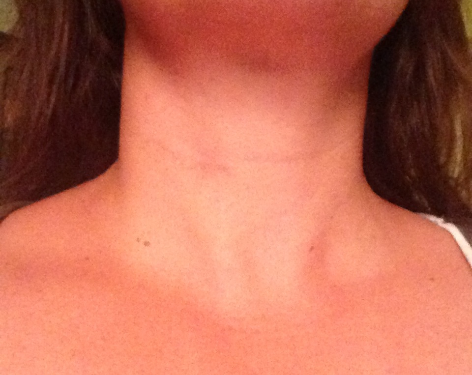 The Scar: Photo Retrospective | ACDF: Neck is Wack