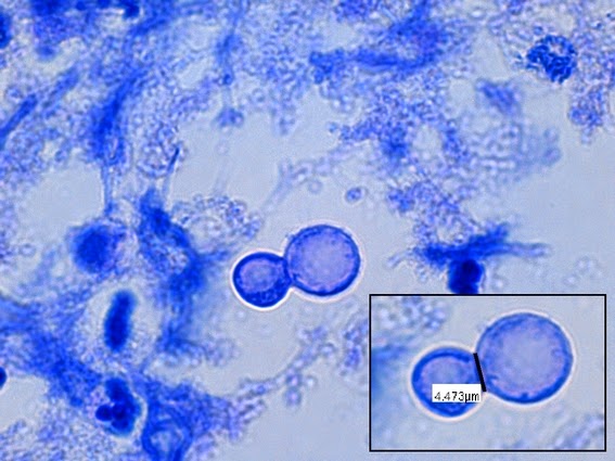 Fun With Microbiology (What's Buggin' You?): Blastomyces dermatitidis