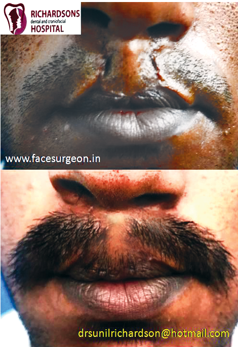 Lip revision surgery - Richardson dental and craniofacial Hospitalposts