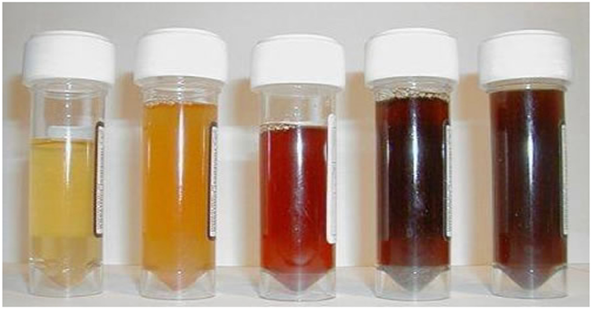 BLOG TADEU MIRACEMA : COR DA URINA PODE REVELAR DOENÇAS RENAIS OU DO FÍGADO