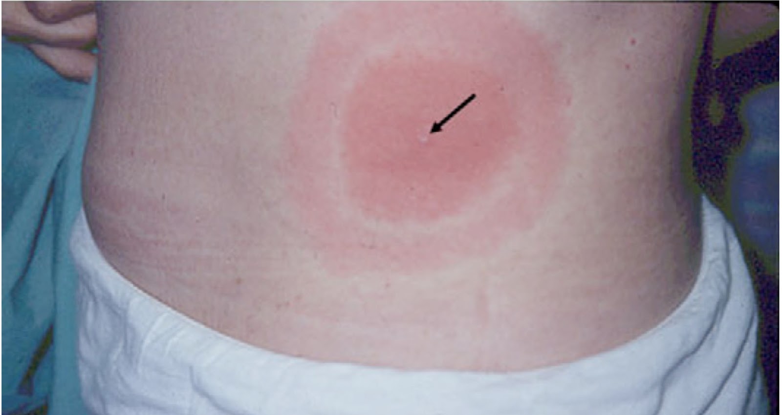 Doc Cottle's Desk: Lime's Disease - some underappreciated elements.