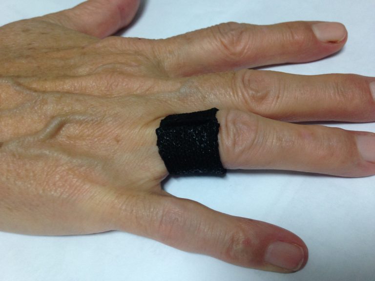 Discapacidad y salud: Dedo gatillo o resorte - terapias