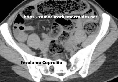 ELIMINACIÓN: Extracción manual de fecalomas.