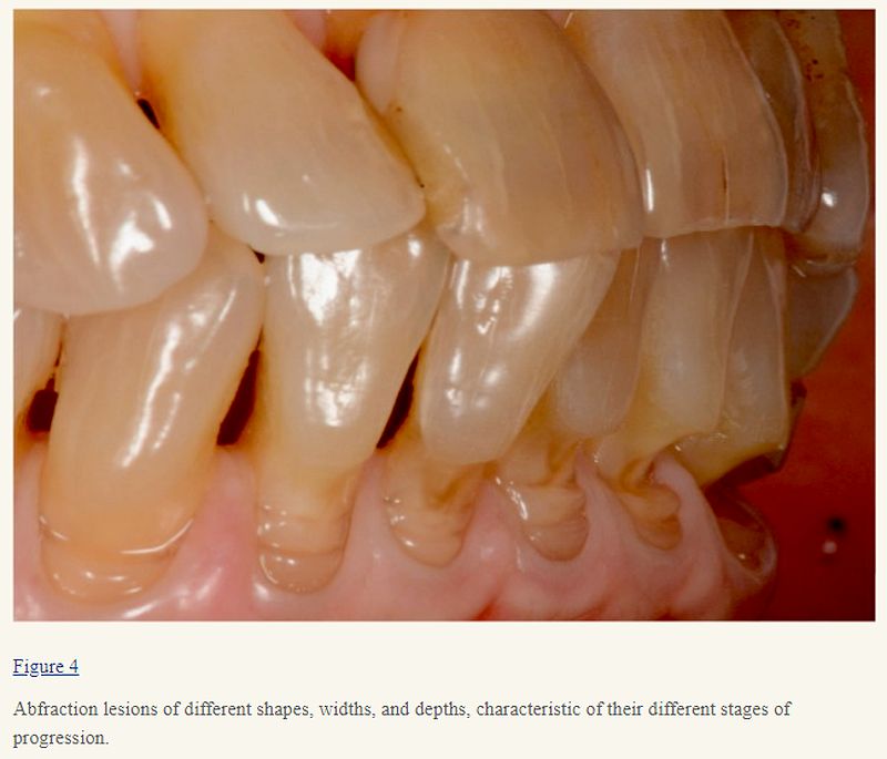 ABFRACTIONS LESIONS: Etiology, diagnosis, and treatment options