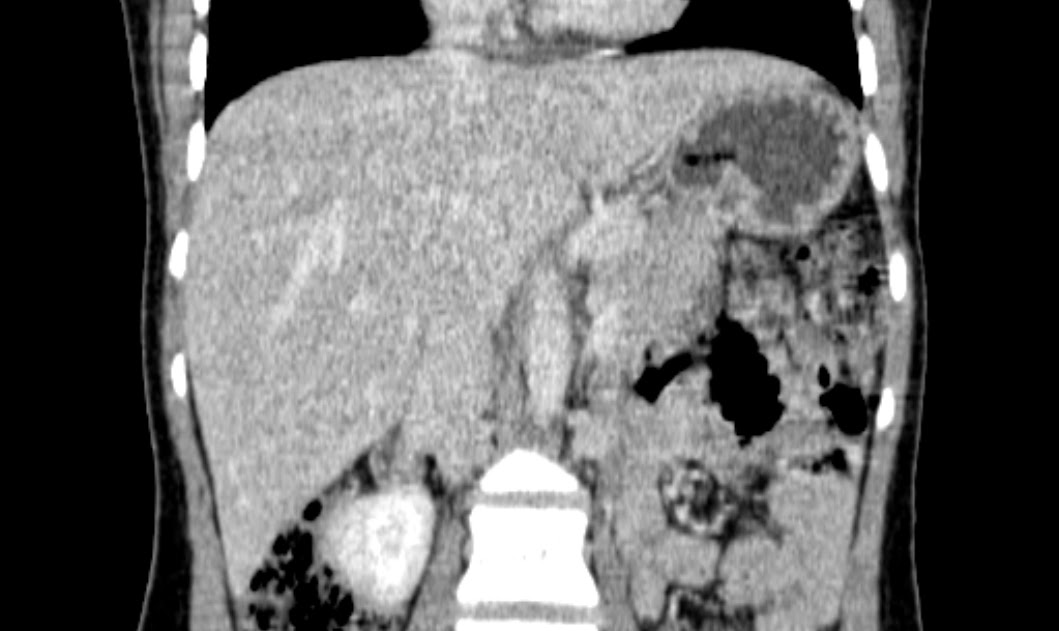 Ultimate Radiology : Pseudolesion : Papillary Process of Caudate Lobe