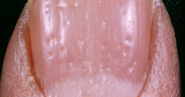 Nail pitting: Nail Pitting Psoriasis Pictures