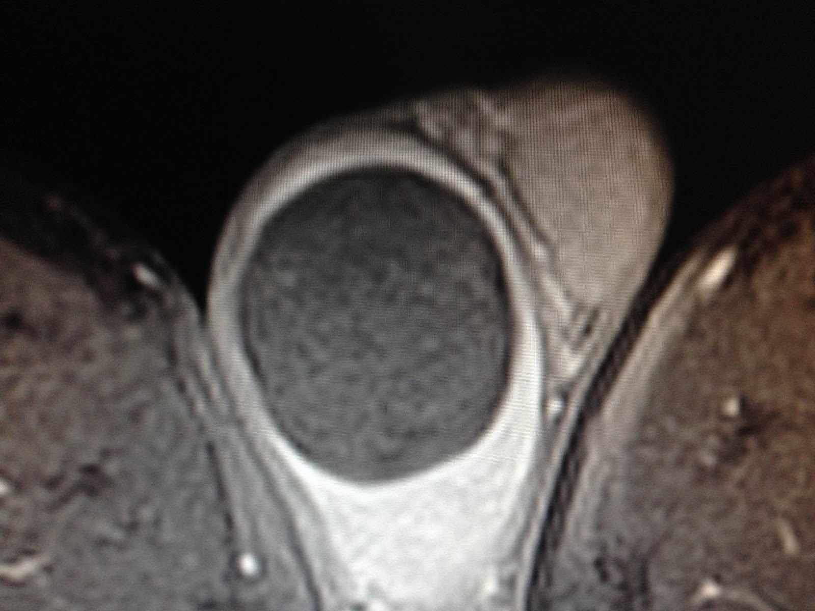 VIETNAMESE MEDIC ULTRASOUND: CASE 434: TESTIS TUMOR, Dr PHAN THANH HẢI ...