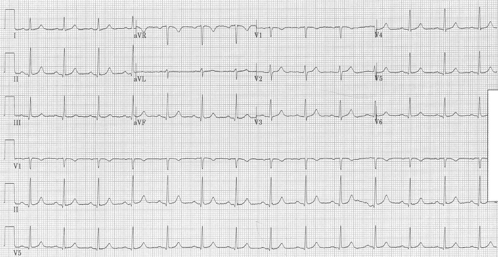 ECG of the Week: ECG of the Week - 28th November 2016 - Interpretation