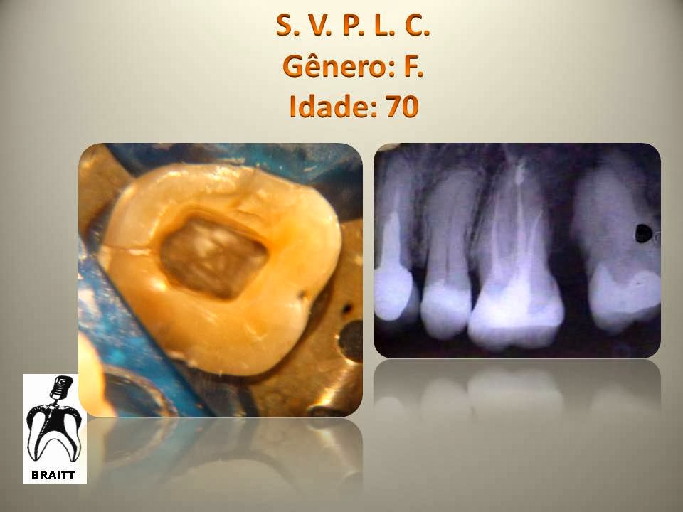 Endodontia Dr. Henrique Braitt: Tratamento endodôntico de molar ...