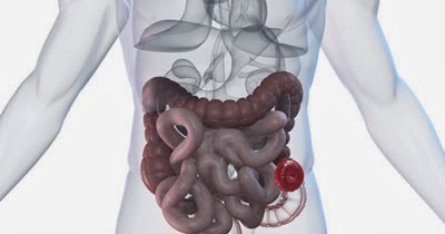 Vídeo Ostomia sem Tabu - Doença de Crohn e Colite Ulcerativa