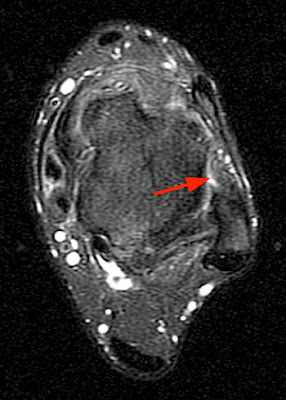 MRI Musculo-Skeletal Section: Accessory anterior inferior tibio-fibular ...