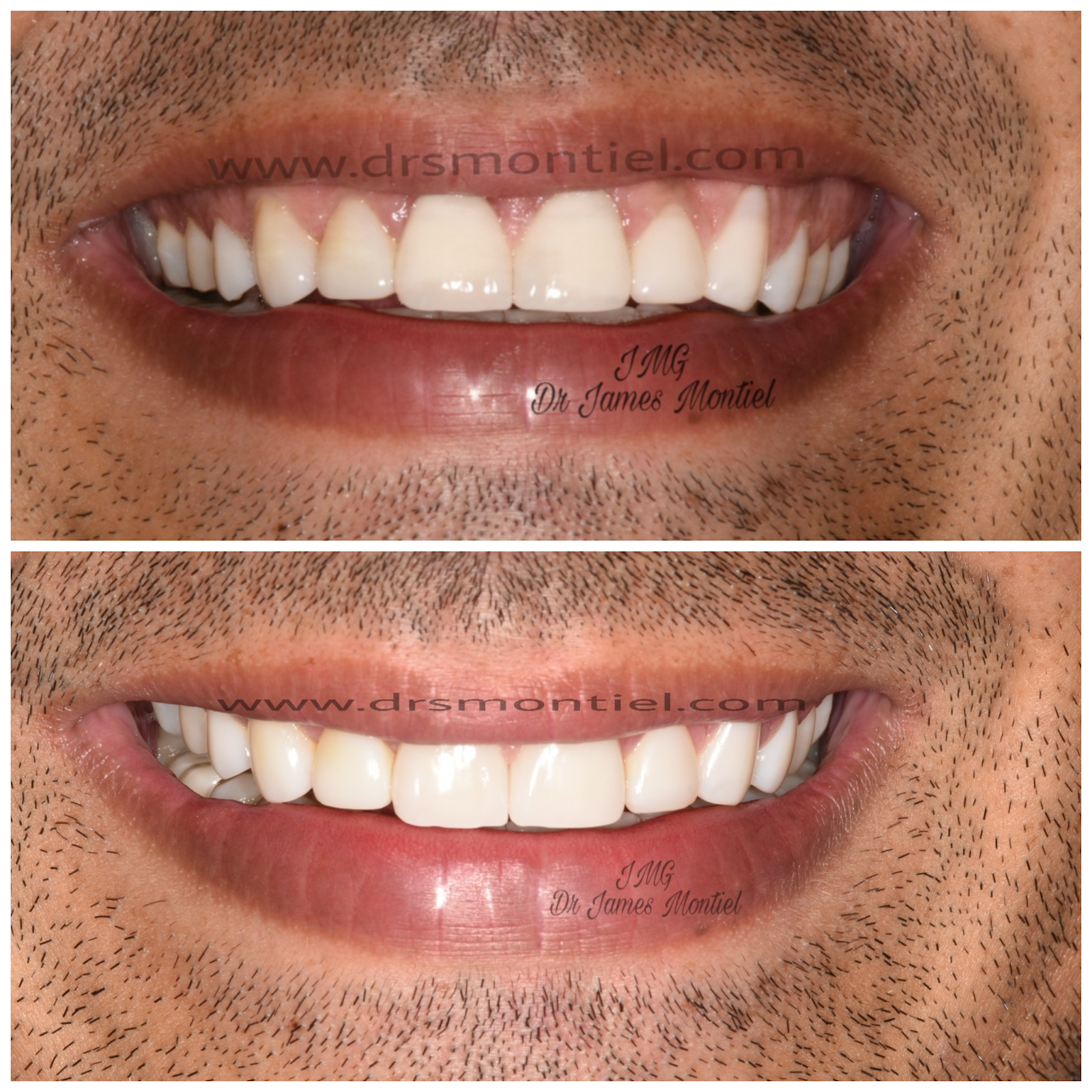 Botox, Acido Hialurónico, Bichectomia, Invisible Touch Hilos Pdo