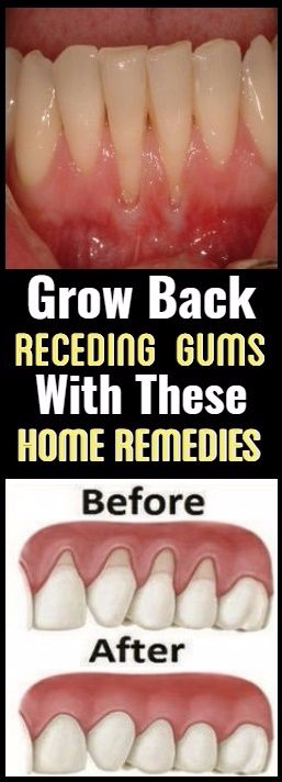 Grow Back Your Receding Gums With These Natural Remedies ! | Health Pins