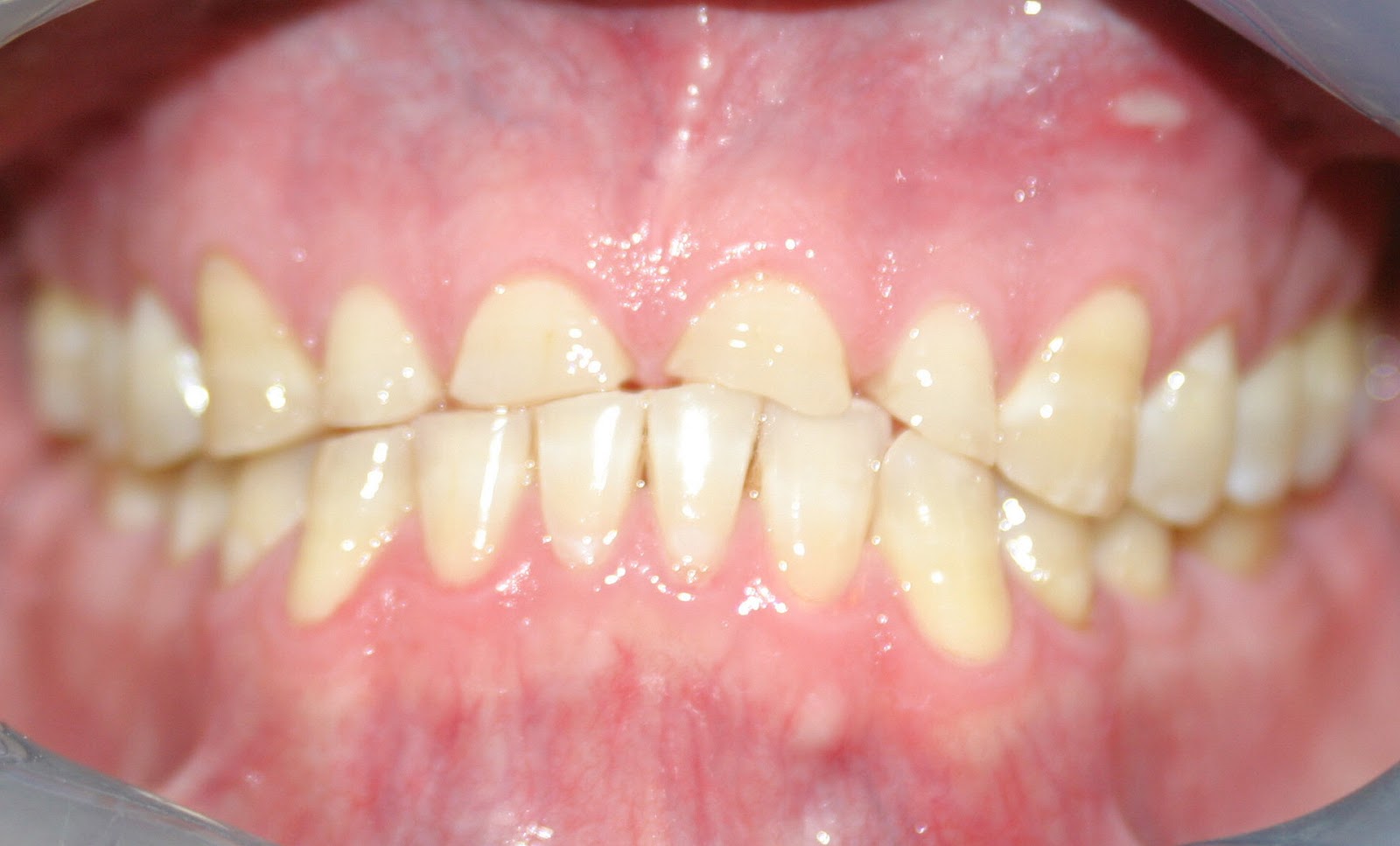 James R. Waters, DDS, MSD, PA: Closing space between upper teeth (and ...