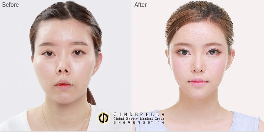 Cinderella Plastic Surgery: Cinderella Plastic Surgery, Facial Contour ...