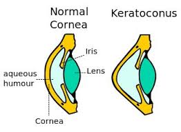 IVF & Keratoconus Progression