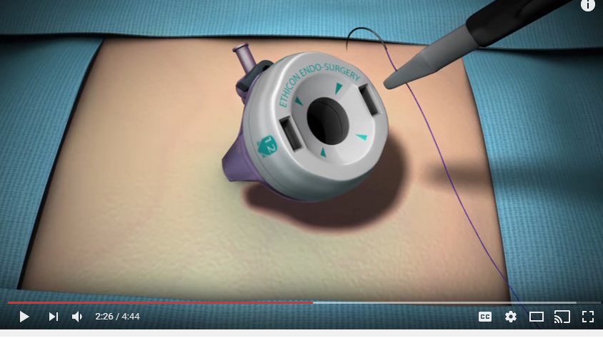 Ob/Gyn Updated : Ethicon STRATAFIX™ Spiral Plus Devices transforms ...