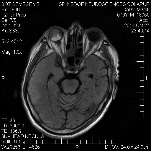 Neuroradiology Cases: Choroidal detachment MRI