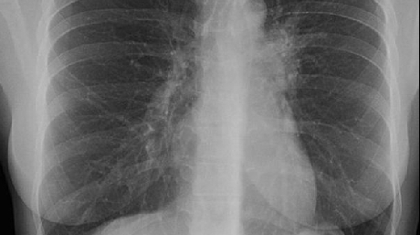 Septian Nur Alam: LP TB PARU DAN ASKEP TB PARU BERIKUT GAMBAR