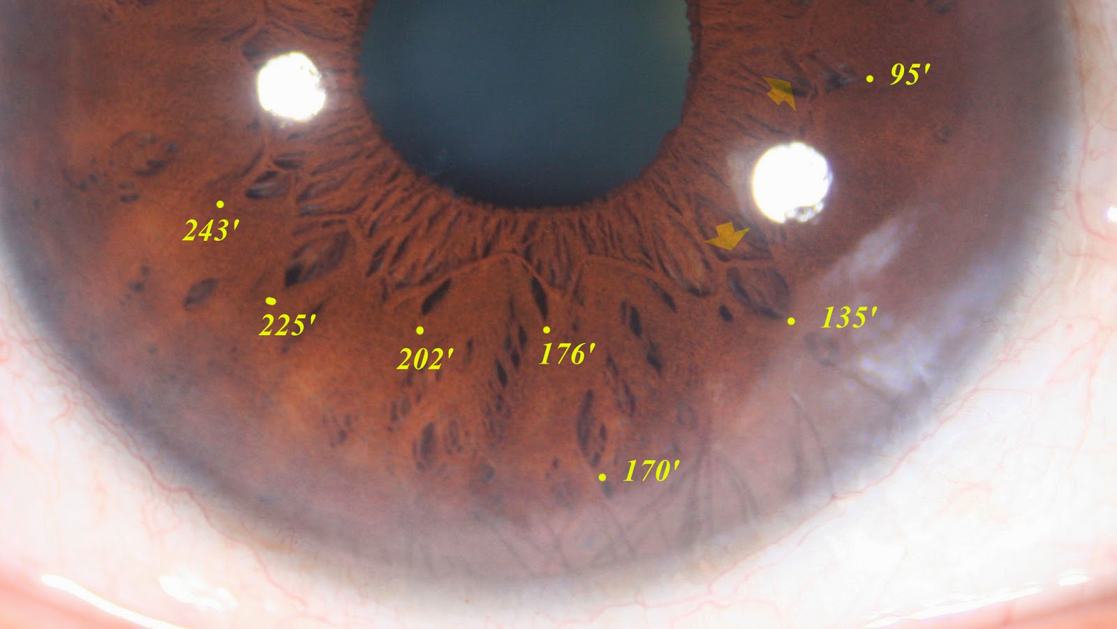 Modern & Multidimensional Iridology: Lacunae & Crypts at the Internal ...
