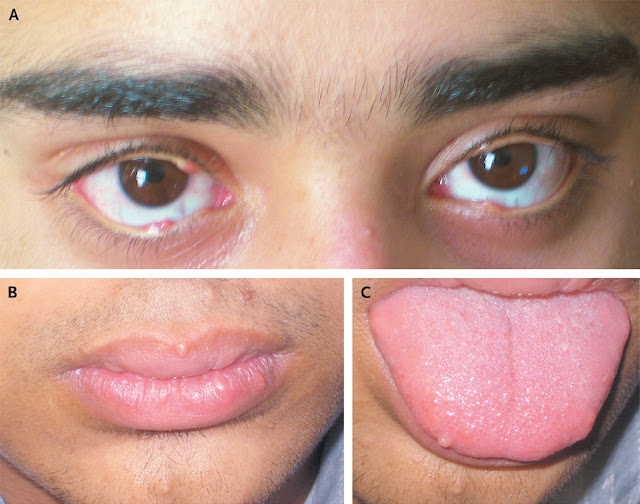 Papules on the Eyelids, Lips, and Tongue