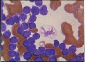 Células importantes en hematología: LEUCEMIA LINFOIDE AGUDA L1 ...