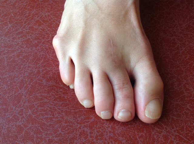 Foot and Ankle Problems By Dr. Richard Blake: Friday's Patient Problem ...
