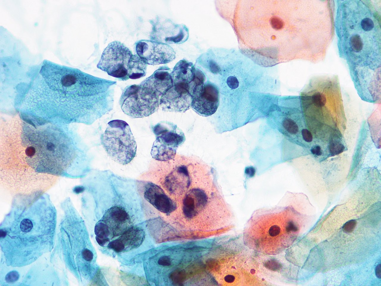 dudas gine: TEST DE PAPANICOLAU (citologia cervicovaginal)