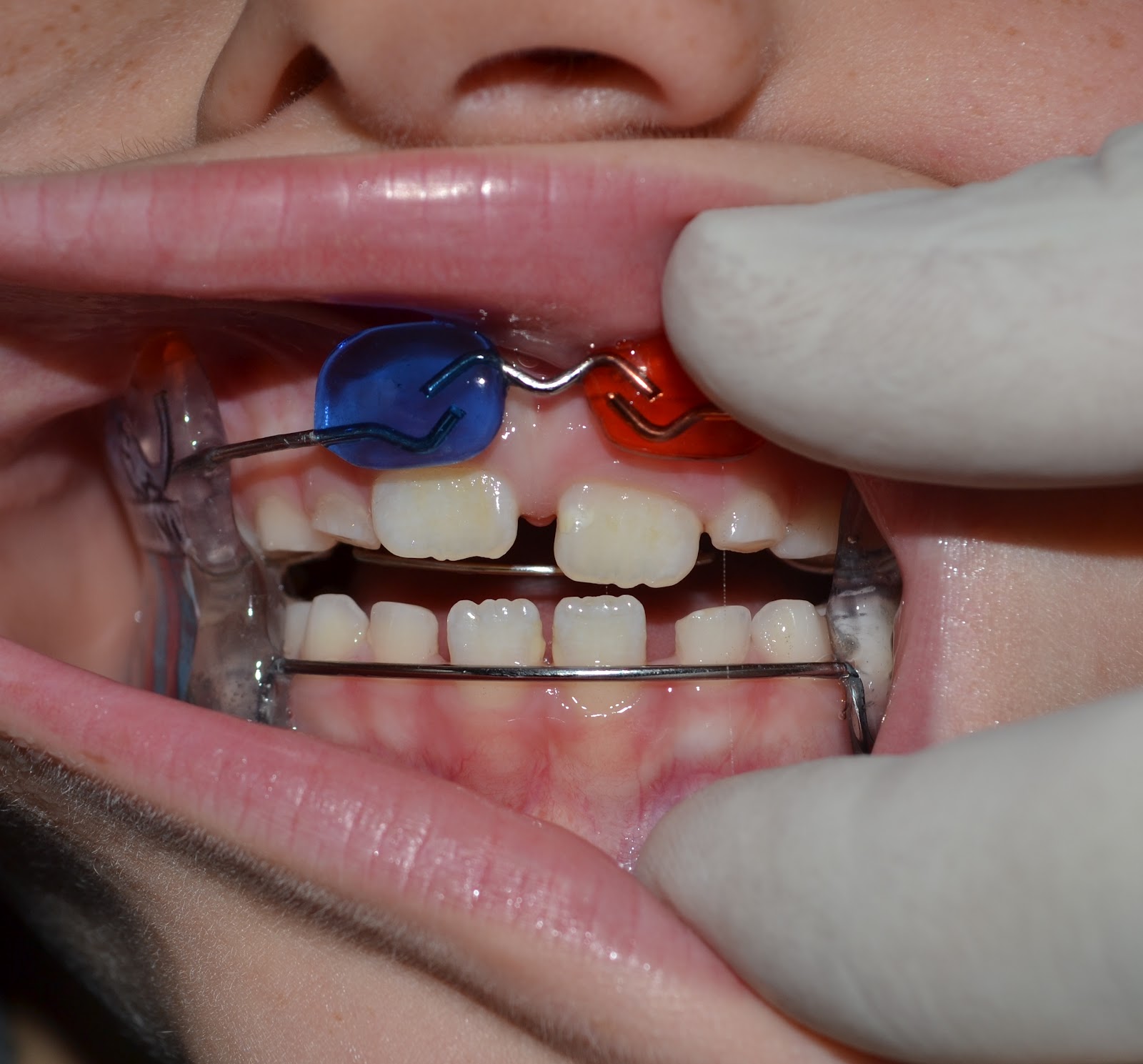 Laboratorio Ortodontico MRdental: FRANKEL 3