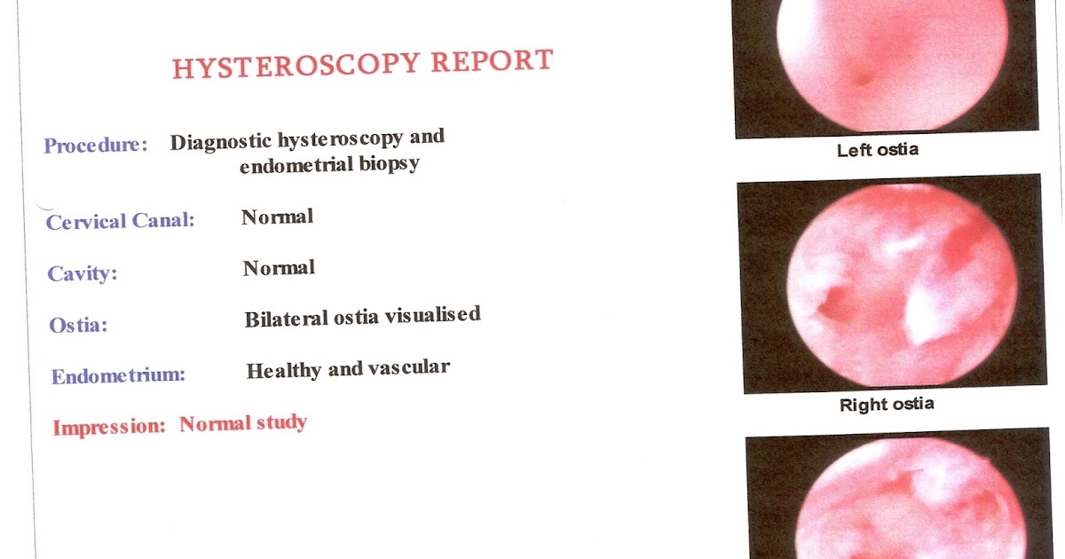 IVF ... IUI ... ICSI ... ART ...: My Hysteroscopy Report