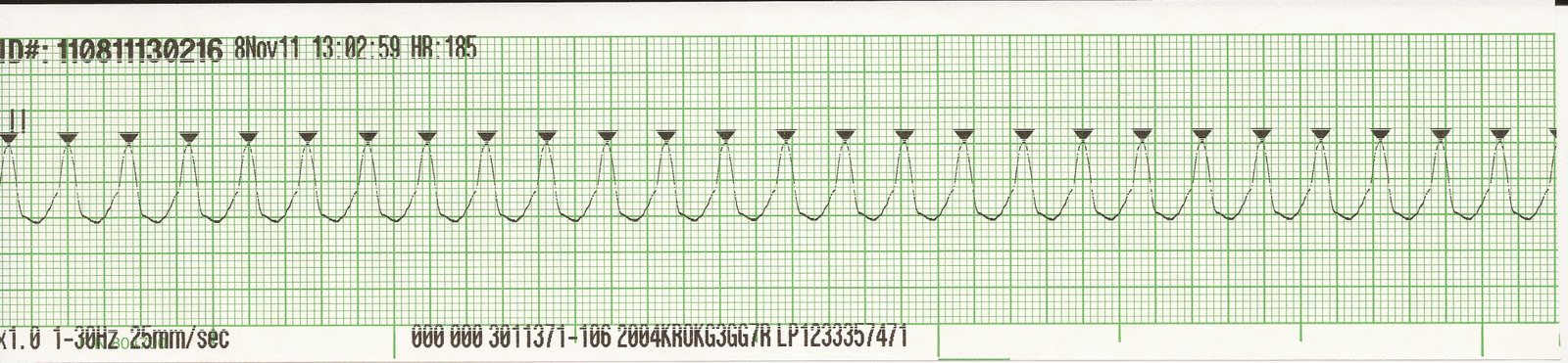 ACLS review: Wide Complex Tachycardia (WCT) Part 7