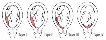 The Well-Rounded Mama: Placenta Previa and Prior Cesarean