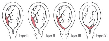 The Well-Rounded Mama: Placenta Previa and Prior Cesarean