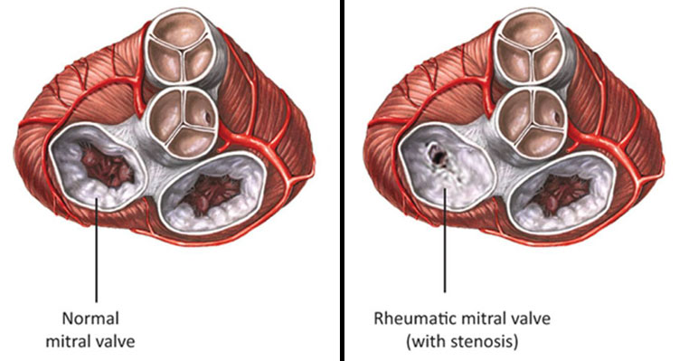 What is Rheumatic Heart Disease and Fever?
