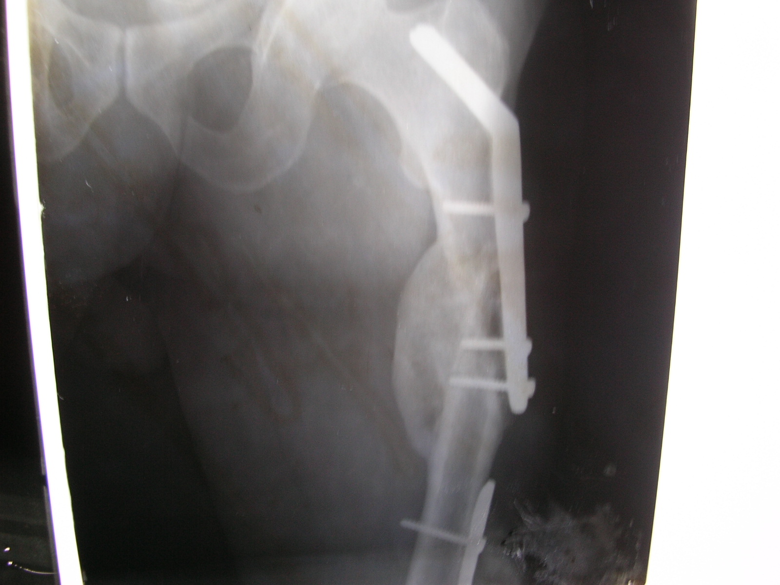 X-rays and Slides: Implant failure of the DHS plate