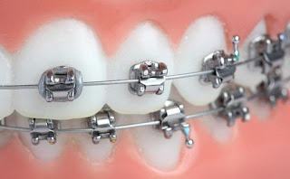 Perawatan gigi khusus untuk si Behel! - Retno Fitri