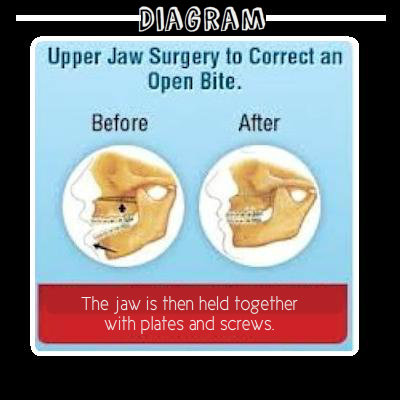 Jaw Surgery Blog: Open Bite Edition
