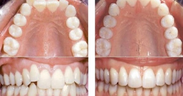 Sunggu Menakjubkan !! Gigi yang Tidak Rapi Bisa Rapi Dengan Cara Mudah ...