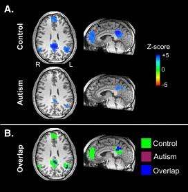 Autism: A Complementary and Alternative Approach: Diagnosis via Brain ...