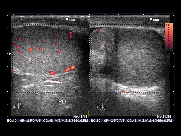 KLINIK PRATAMA MAKMUR JAYA: GAMBARAN USG TORSIO TESTIS/BUAH ZAKAR