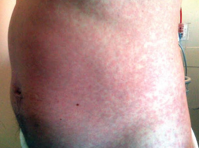 Maculopapular Rash