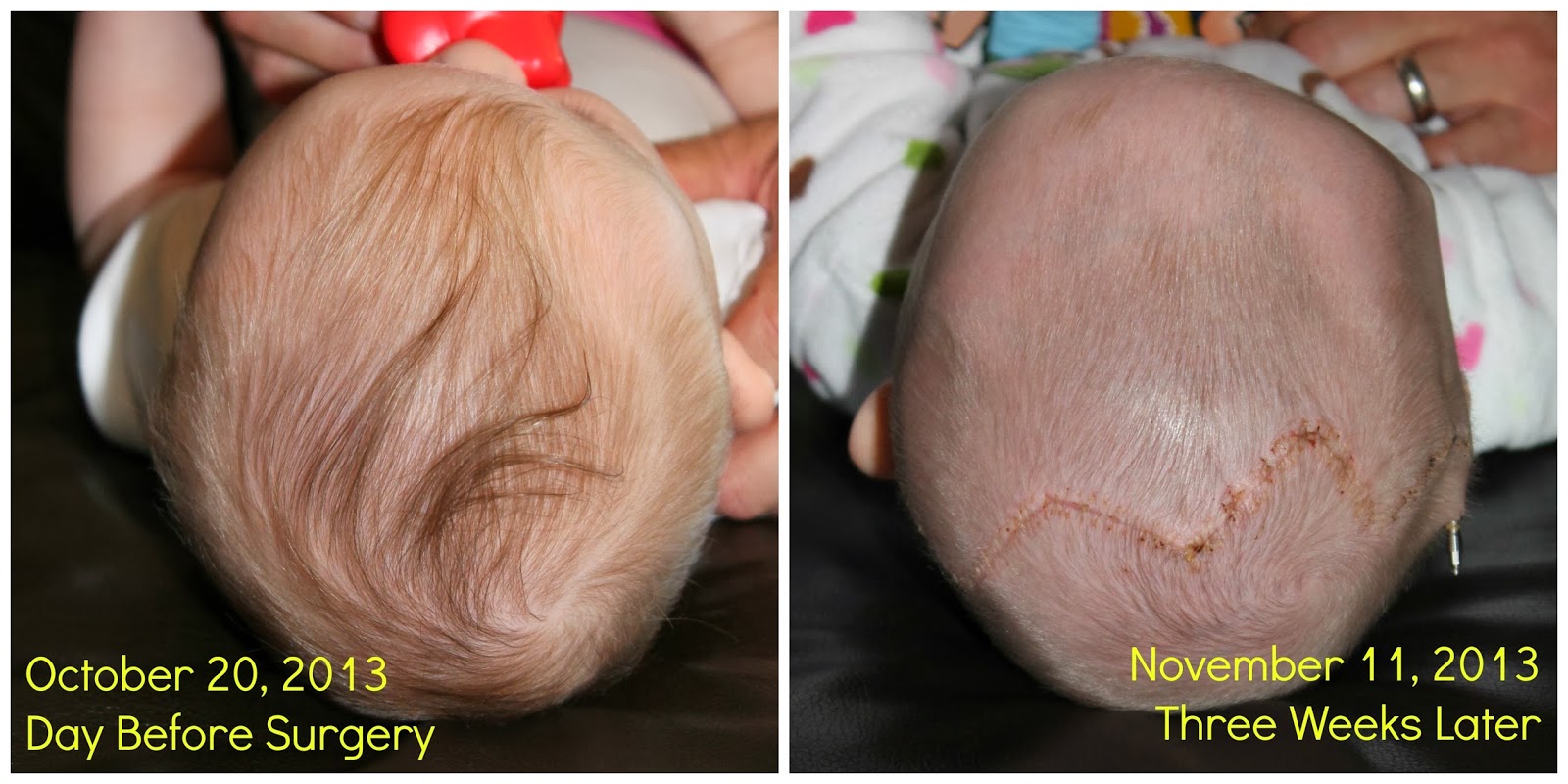Leah's Right Coronal Craniosynostosis: Three Weeks Post-Op Progress