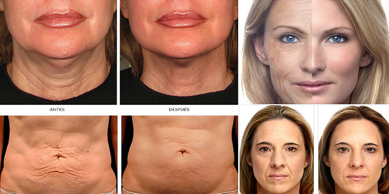 Look at How to Eliminate Flaccidity and Tensar the Skin Naturally YOU ...