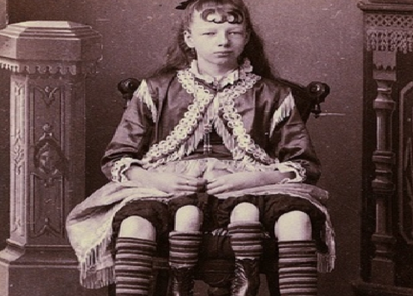 Josephine Myrtle Corbin: conheça a história da mulher com quatro pernas ...