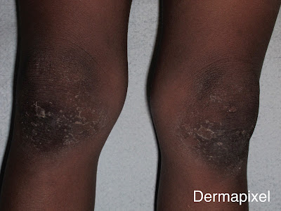 Dermapixel: febrero 2018