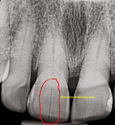 Omni Dental Group: Cracked Tooth Syndrome (CTS)