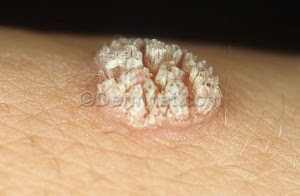 Organic Beauty: How to remove warts (naturally)