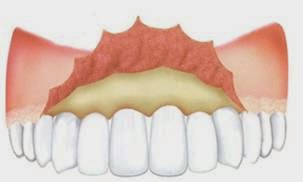 Apuntes De Odontología: principios generales en el diseño de colgajos y ...