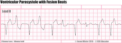 ECG Educator Blog : Parasystole