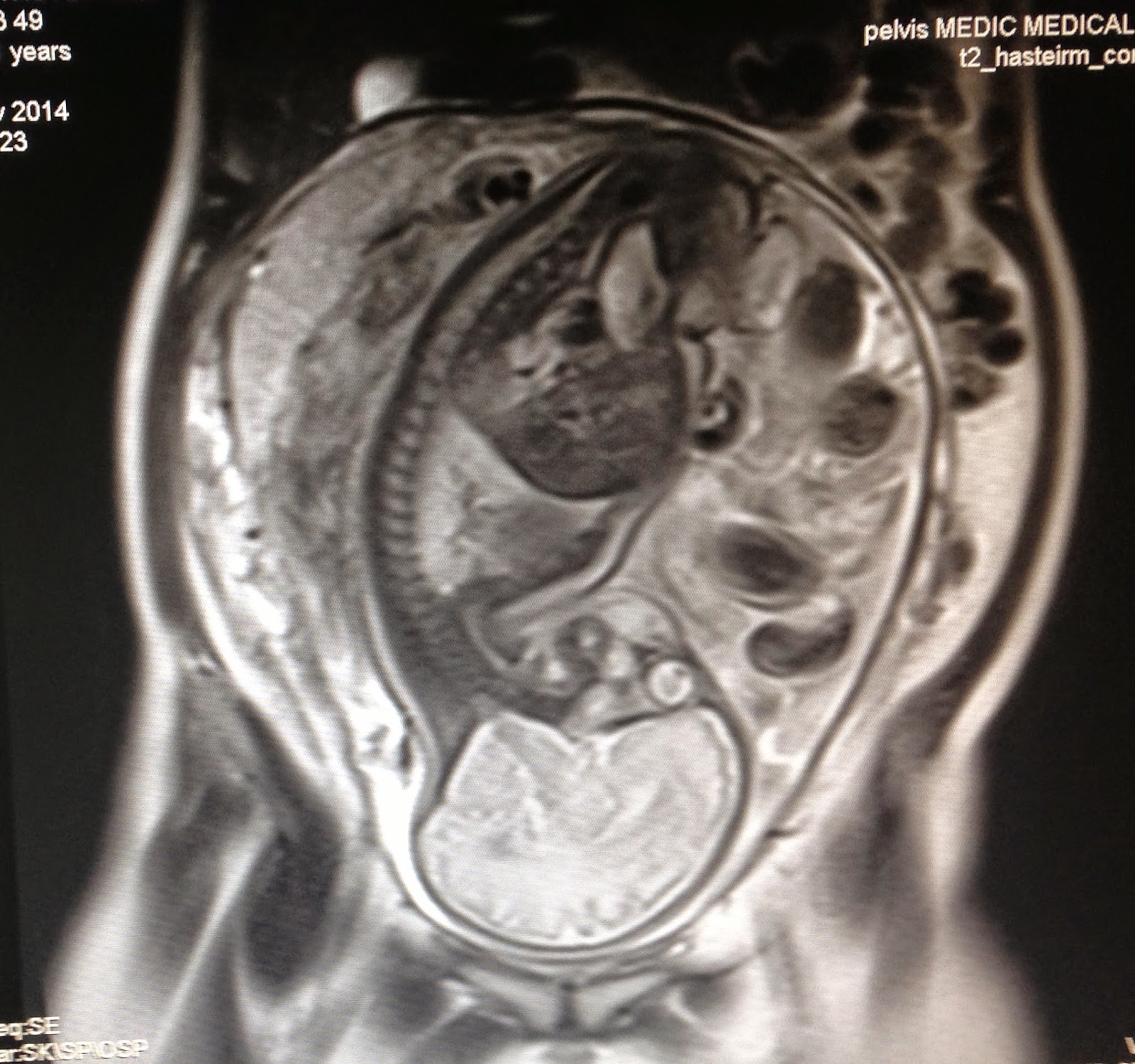 VIETNAMESE MEDIC ULTRASOUND: CASE 280: FETUS ONE KIDNEY in ...